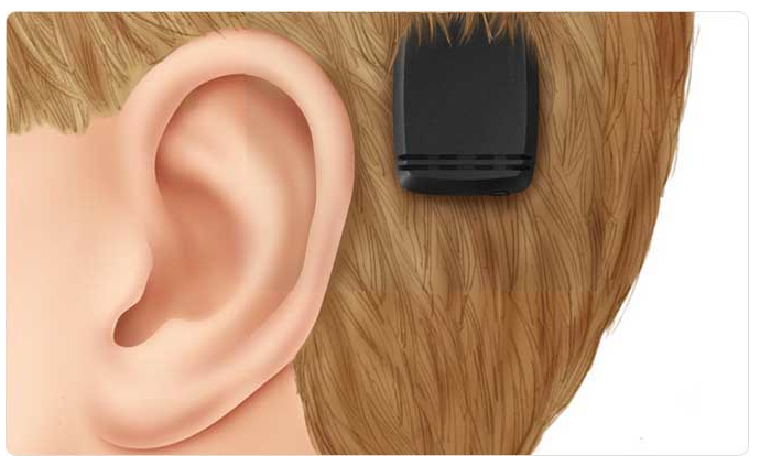 The Drake Naylor Story: Bone Anchored Hearing Aid Implant