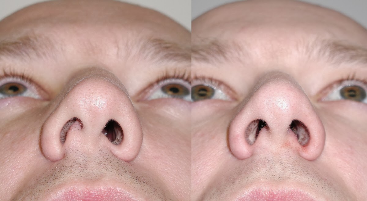 Deviated Nasal Septum (DNS)