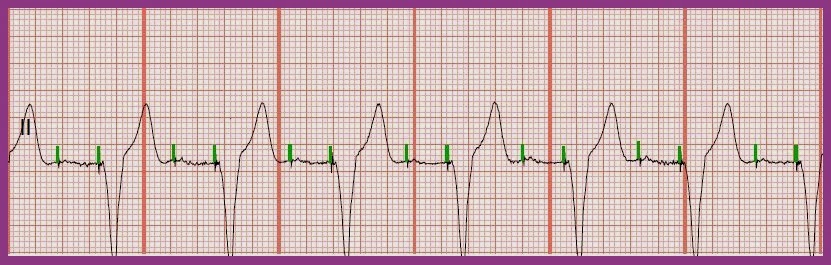 EKG Rhythm Strip Quiz 205