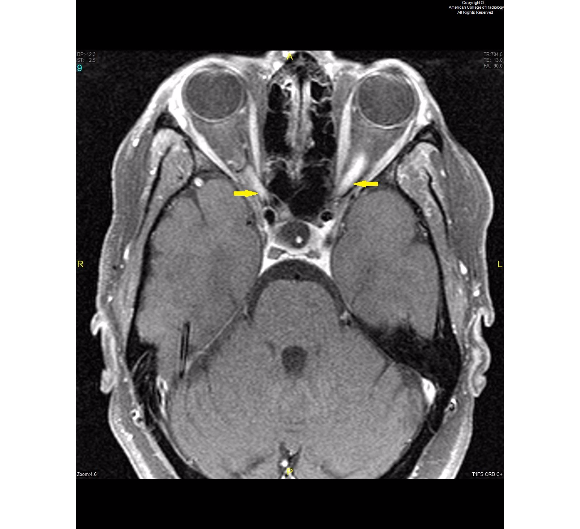 EL RINCÓN DE LA MEDICINA INTERNA: NEUROMIELITIS ÓPTICA (ENFERMEDAD DE ...