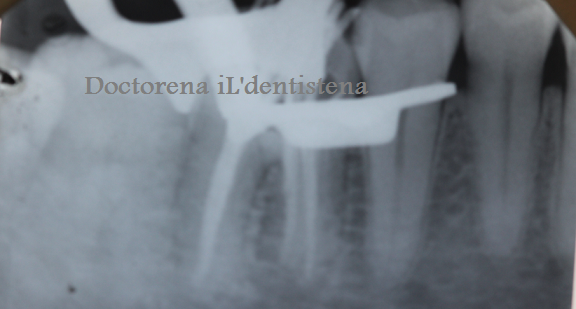 My Dental Diary: 2nd endo case 2012 , tooth #46