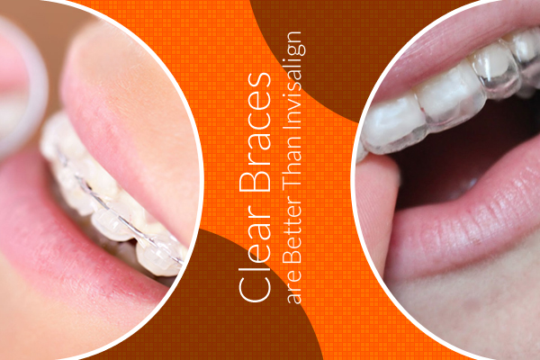 Ceramic Braces are Better Than Invisalign - Orthodontics Treatment in UK