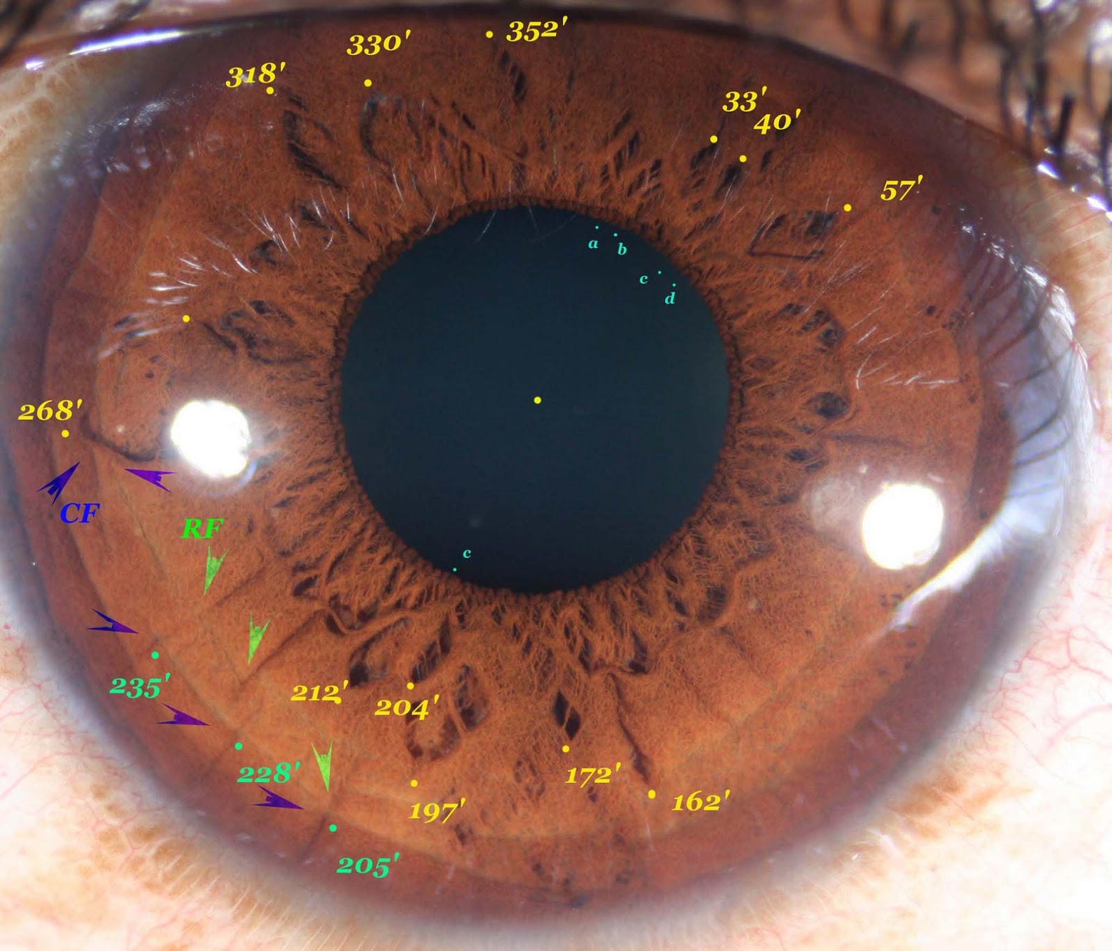 Modern & Multidimensional Iridology: Lacunae at External Border of the ...