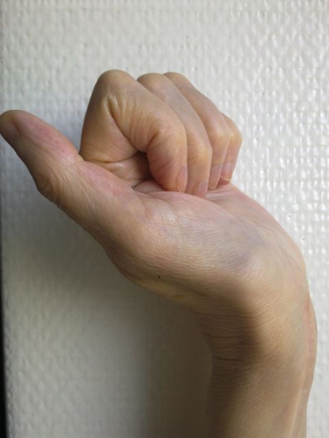 Käden kuntoutus on kestävyyslaji: Jos kädessä sormi tai sormet alkavat ...