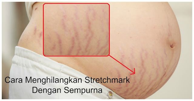 Bekas Stretchmark Setelah Melahirkan ini Ternyata Bisa di Hilangkan Loh ...