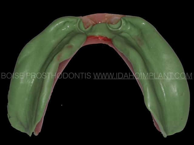 Boise Idaho Prosthodontics