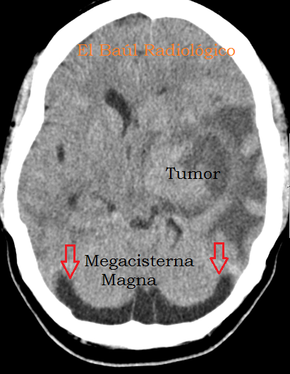 El Baúl Radiológico: ASPECTO DE LA CISTERNA MAGNA EN TOMOGRAFÍA ...
