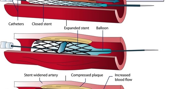 STENT. DILATATION OF THE ARTERY | MY HEALTH LEGACY