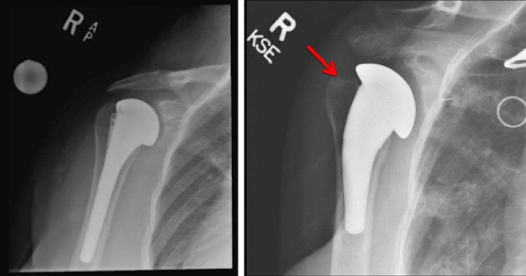 Shoulder Arthritis / Rotator Cuff Tears / Shoulder Pain : Is there an ...
