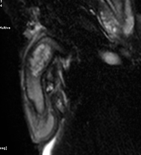 Cavernosal Hematoma-MRI - Sumer's Radiology Blog