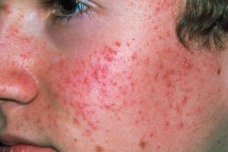 Dr. Modi's Homoeopathic Clinic: ACNE(PIMPLES) AND HOMOEOPATHY