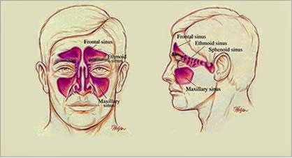 Healthy Family Wellness: SINUSITIS/RESDUNG