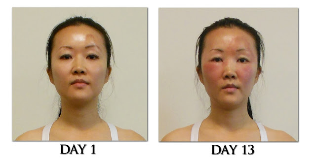 My Staph Story: My Staph Story