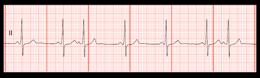 Various Rhythms with PACs