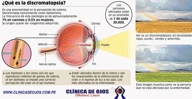 Clínica de Ojos Oftalmic Láser: DISCROMATOPSIA