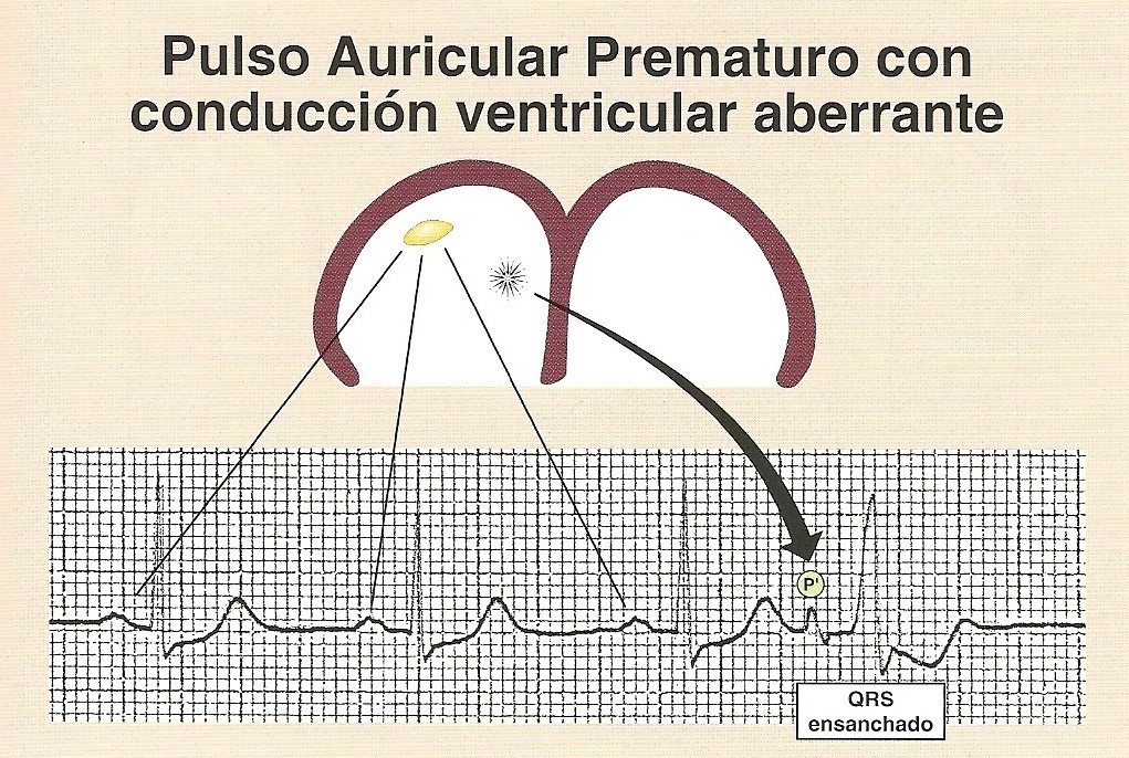 Electrocardiograma: Extrasístoles supraventriculares con conducción ...