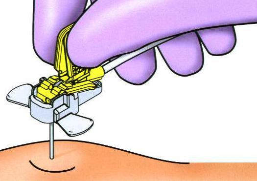 jm's Adventure with Multiple Myeloma: Intravenous Access Port - Bard ...