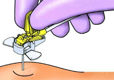 jm's Adventure with Multiple Myeloma: Intravenous Access Port - Bard ...