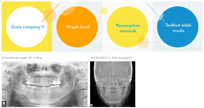 Apa itu operasi reduksi rahang persegi?