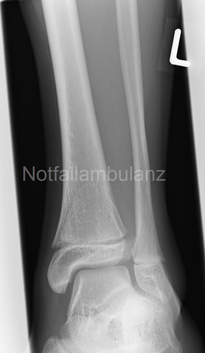Brennpunkt Notaufnahme: Fall 16: Kindliche Distorsion des OSG Befunde ...