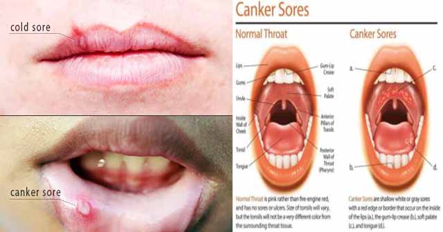 Natural Home Remedies For Canker Sores natural-home-remedies-for-canker-sores