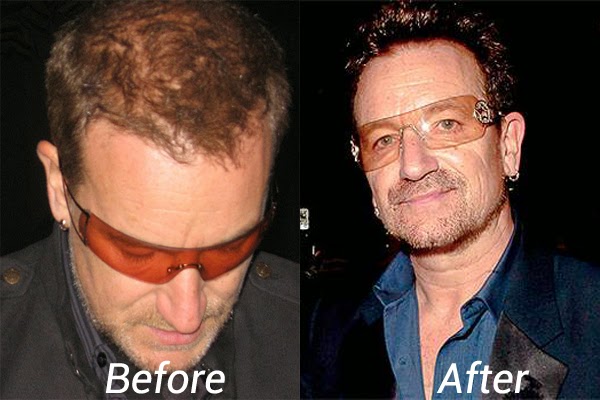 Bono Hair Transplant