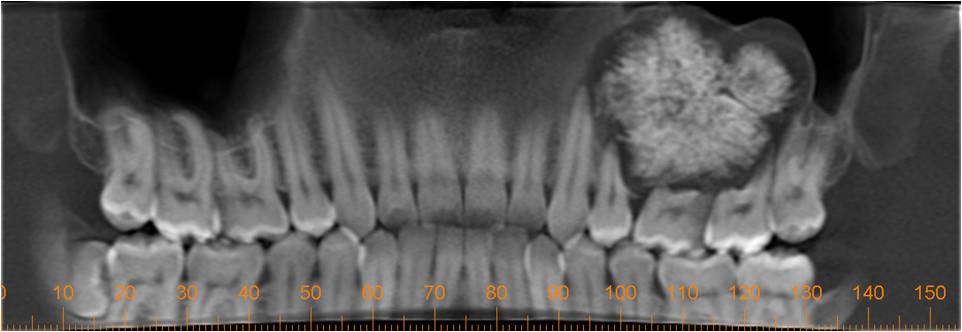 CENTRO ODONTOLÓGICO JUAN GODOY: clasificación de quistes según maxila