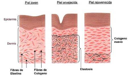 Estética periocular con radiofrecuencia.