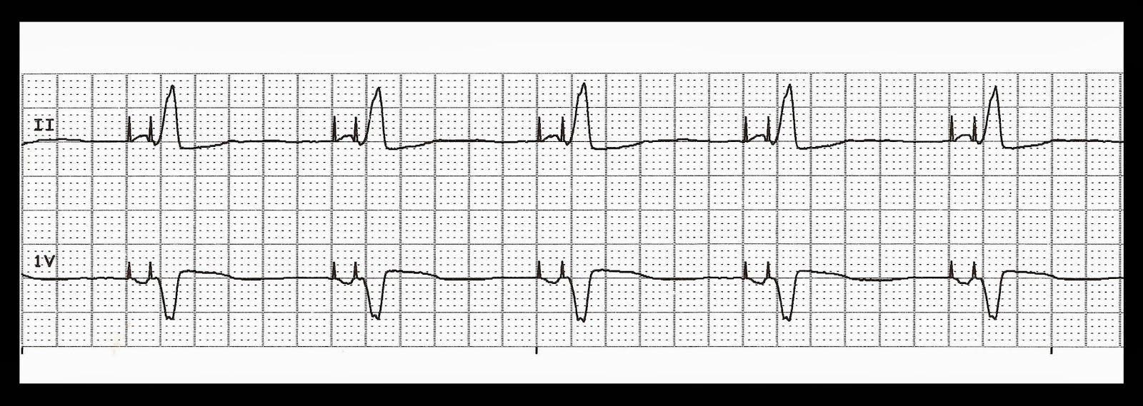 Various Dual Paced Rhythms