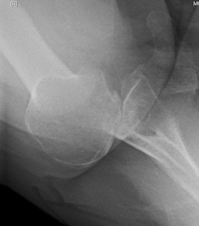 UW Shoulder and Elbow Academy: Addressing glenoid retroversion in total ...