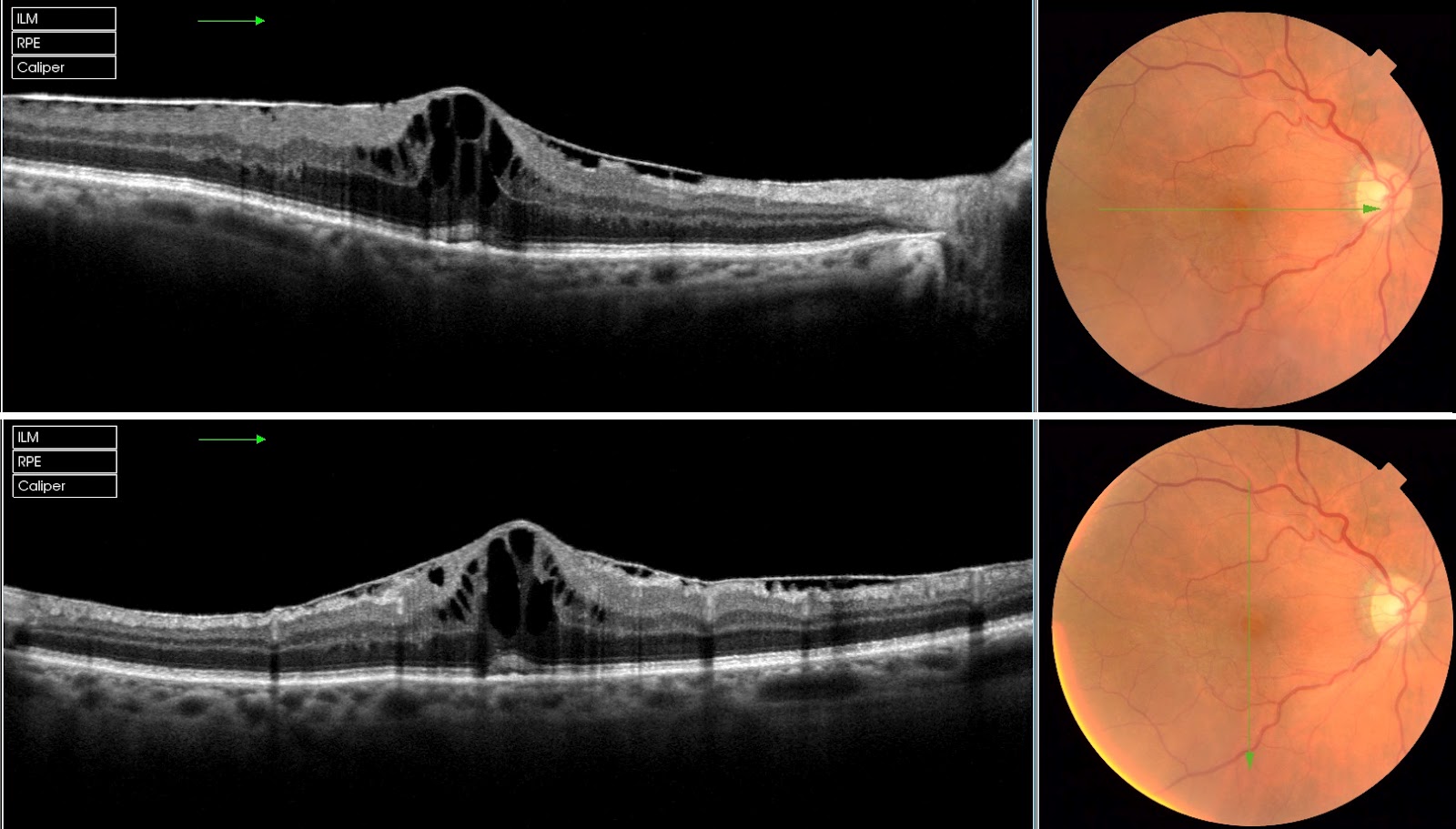 Edema Macular Quístico; Edema Cistoide Macular; Edema Macular Cistoide ...