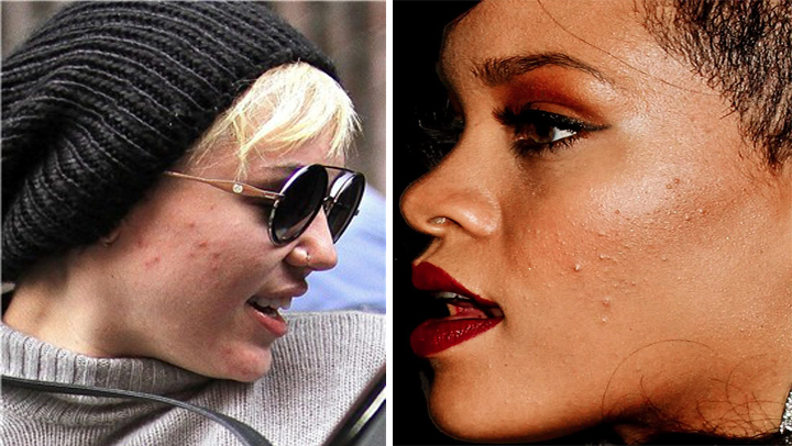 Te Sorprenderás Al Ver Estos 8 Famosos Con Problemas Serios De Acné Que ...