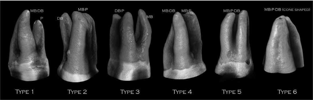 The Root Canal Anatomy Project: Fused Maxillary 2nd Molars ...