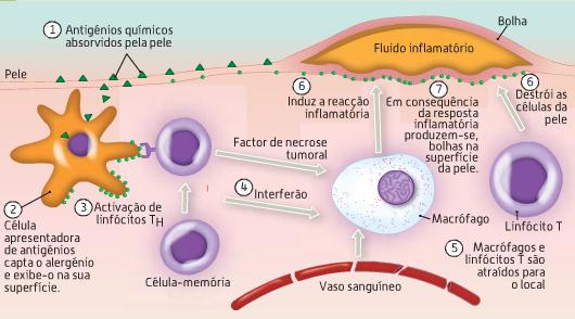 Trabalho de Biologia: Choque Anafilático (Anafilaxia)