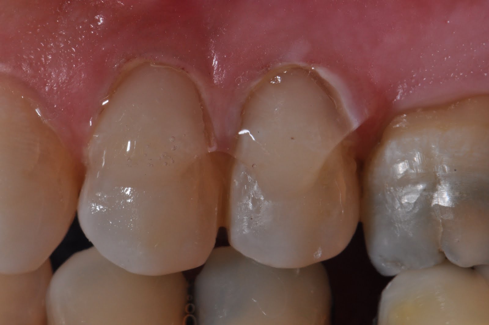 M. Vestphal - Odontologia Estética: Restauração Classe V com Resina ...