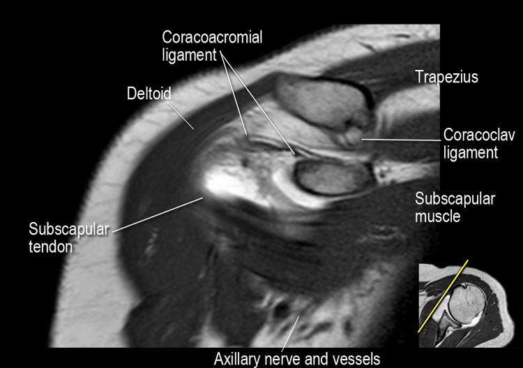 Coracoacromial Ligament Mri