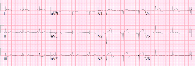 Dr. Smith's ECG Blog: January 2016