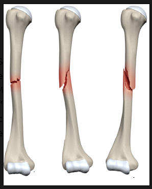 11:50: ¿Qué es una fractura?