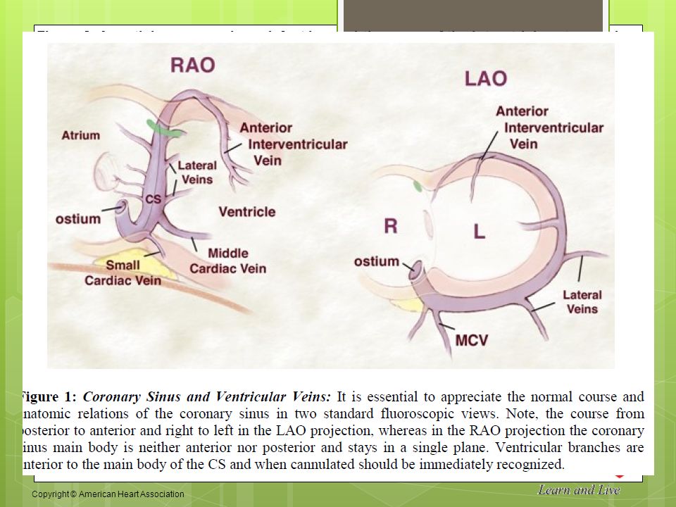 CVT Mohd Farid: Vein Of Marshall And Its Clinical Significant
