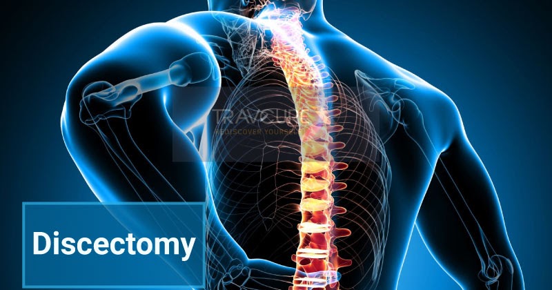 What you should know about Discectomy ~ Medical Tourism In India