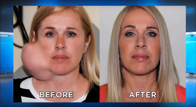 Tumor Jinak Parotis, Tumor Kelenjar Air Liur - Hotcopas