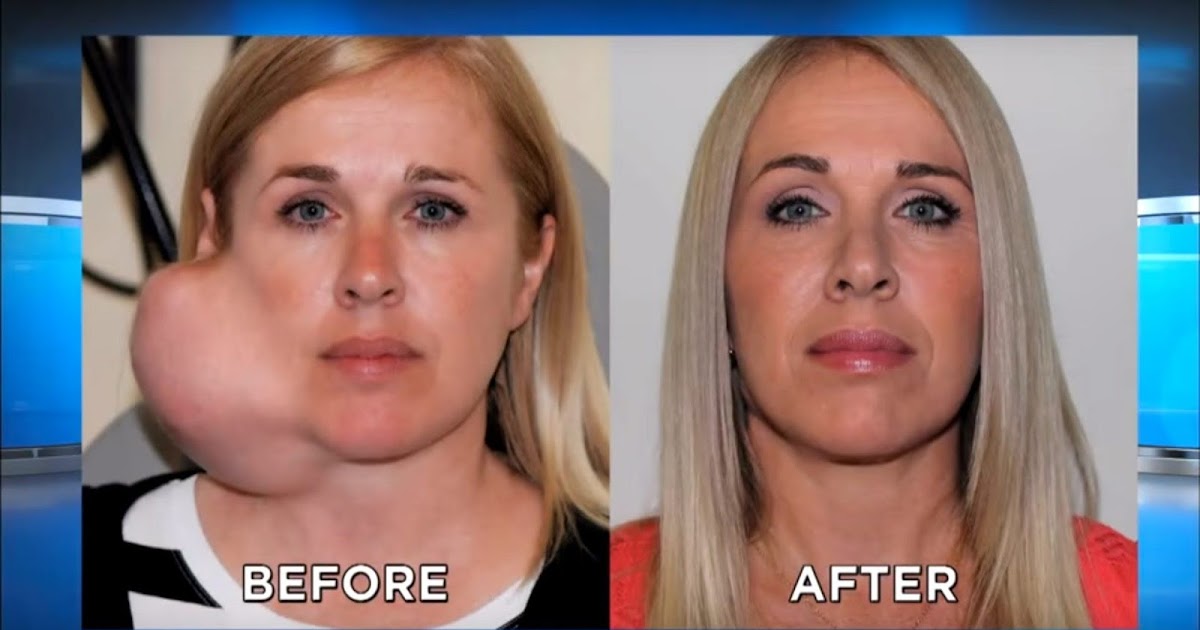 What Is Parotid Tumor? - Teroes