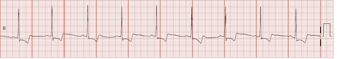 EKG Rhythm Strips 45
