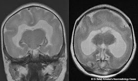 Dr Balaji Anvekar FRCR: Semi lobar holoprosencephaly MRI