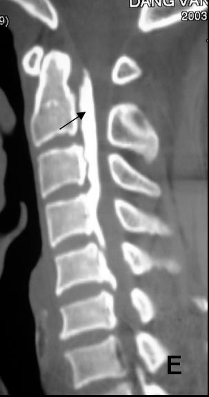 MRI MEDIC CASE STUDIES COLLECTION: Ossification of the posterior ...