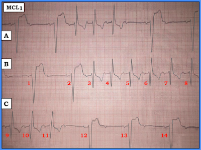 ECG Interpretation