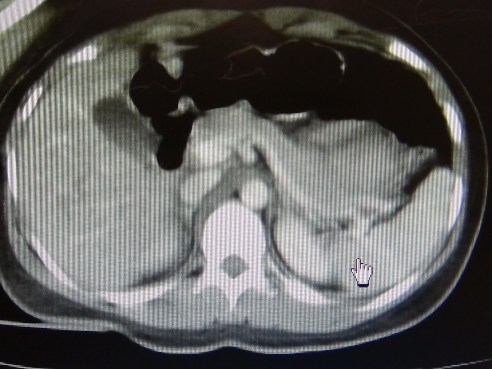 Endoscopia y Cirugía Digestiva: TRAUMA CONTUSO HEPATICO
