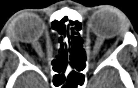 RADIODIAGNOSIS - IMAGE COLLECTION: Focal dehiscnece of lamina papyracea