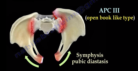 Dr. Nabil Ebraheim's Blogspot: Pelvic Fractures with Bleeding