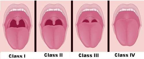 Felipe Senger: Classificação de Mallampati
